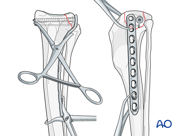 Lag screw and buttress plate fixation for Lateral simple partial ...