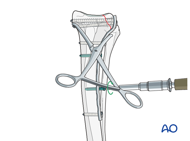 Lag screw and buttress plate fixation for Lateral simple partial ...