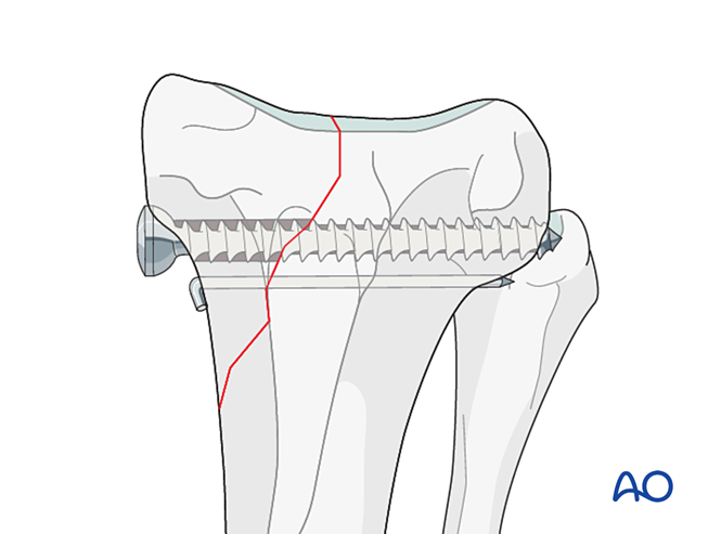Lag screw and buttress plate fixation for Medial simple partial ...