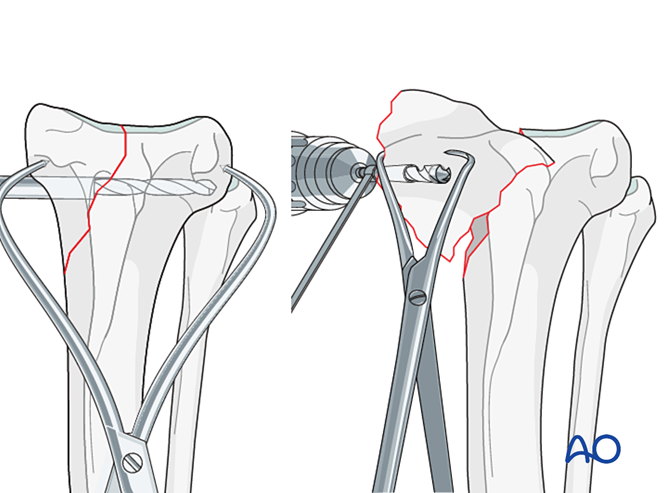Lag screw and buttress plate fixation for Medial simple partial ...