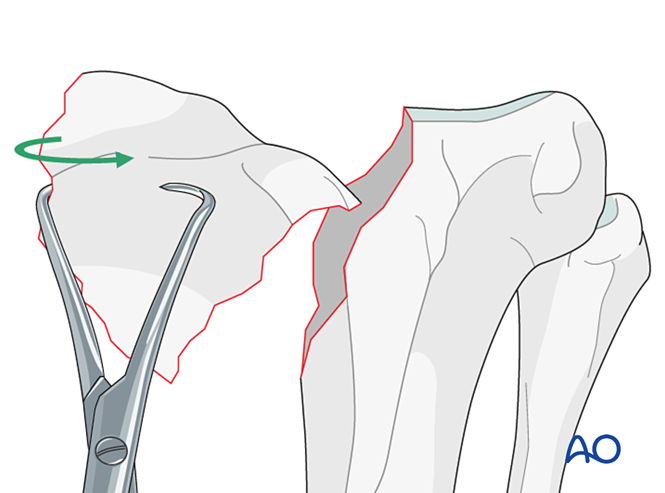 Lag screw and buttress plate fixation for Medial simple partial ...
