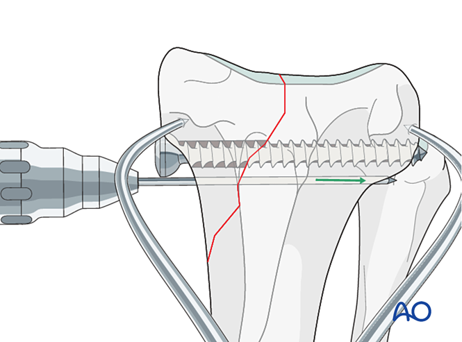 Lag screw and K-wire fixation for Medial simple partial articular fracture