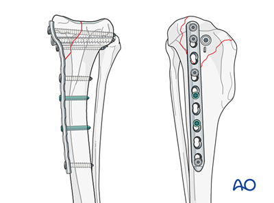 Lag screw and buttress plate fixation for Medial simple partial ...