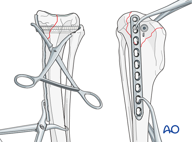Lag screw and buttress plate fixation for Medial simple partial ...