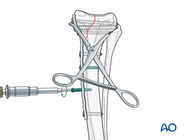 Lag screw and buttress plate fixation for Medial simple partial ...