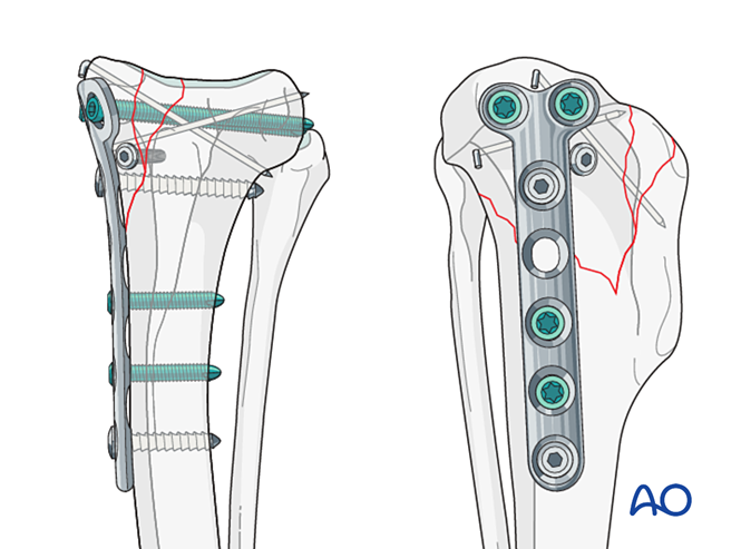 Buttress plate and lag screw with K-wire fixation for Multifragmentary ...