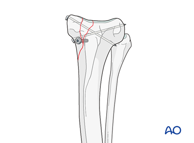 Buttress plate and lag screw with K-wire fixation for Multifragmentary ...