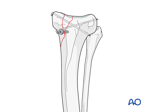Buttress plate and lag screw with K-wire fixation for Multifragmentary ...