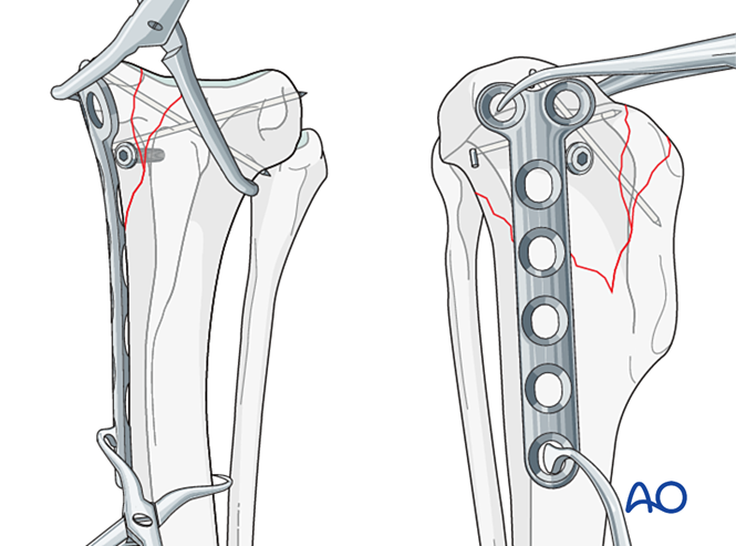 Buttress plate and lag screw with K-wire fixation for Multifragmentary ...