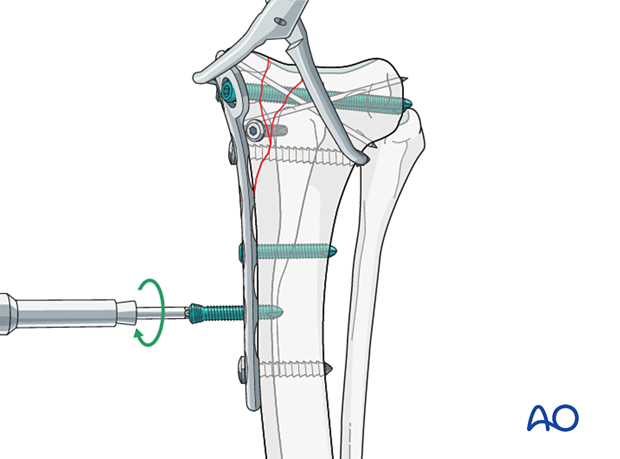 Buttress plate and lag screw with K-wire fixation for Multifragmentary ...