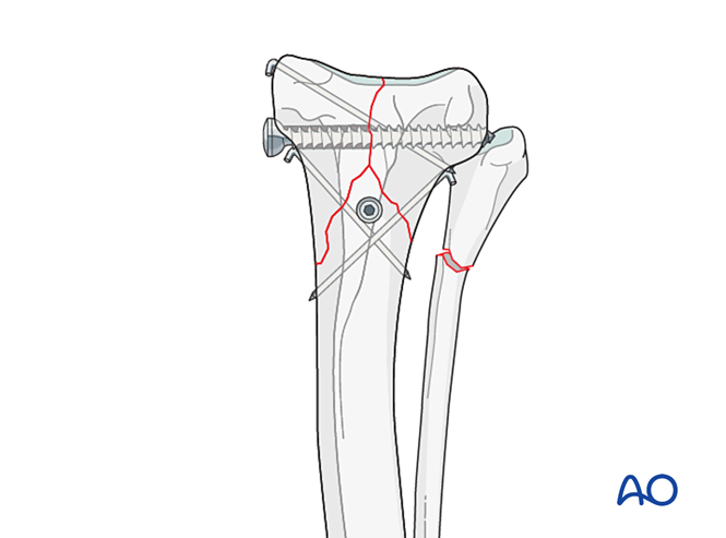 K-wire fixation