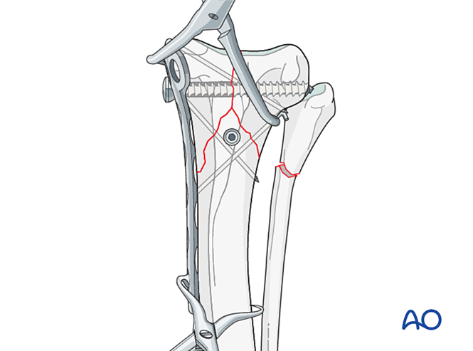 Lag screw and neutralization plate fixation for Simple articular ...