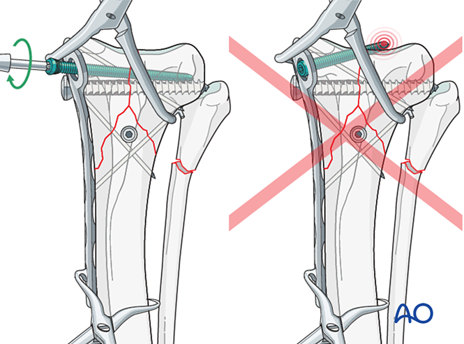 Lag screw and neutralization plate fixation for Simple articular ...