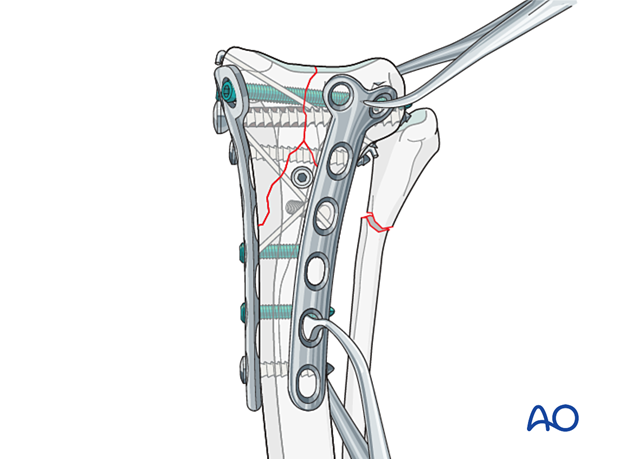 Lag screw and neutralization plate fixation for Simple articular ...