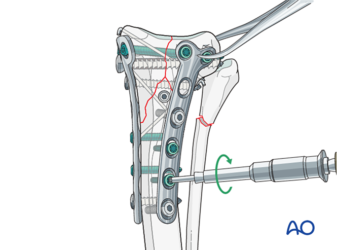 Lag screw and neutralization plate fixation for Simple articular ...