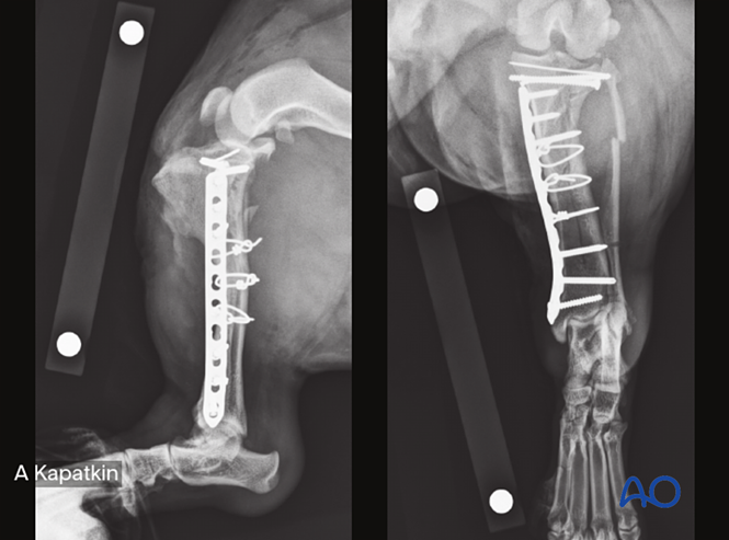 Lag screw and neutralization plate fixation for Simple articular ...