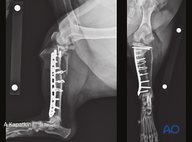 Lag screw and neutralization plate fixation for Simple articular ...