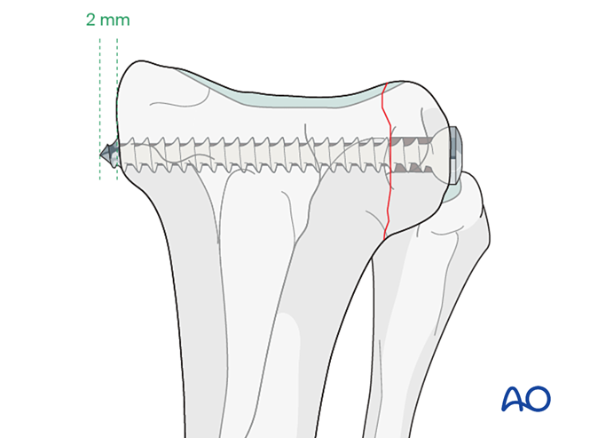 Lag screw fixation