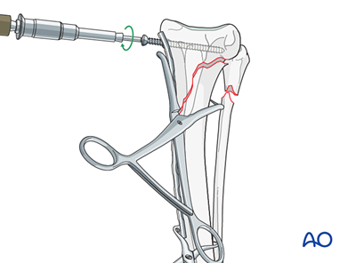 Plating of proximal tibial fractures