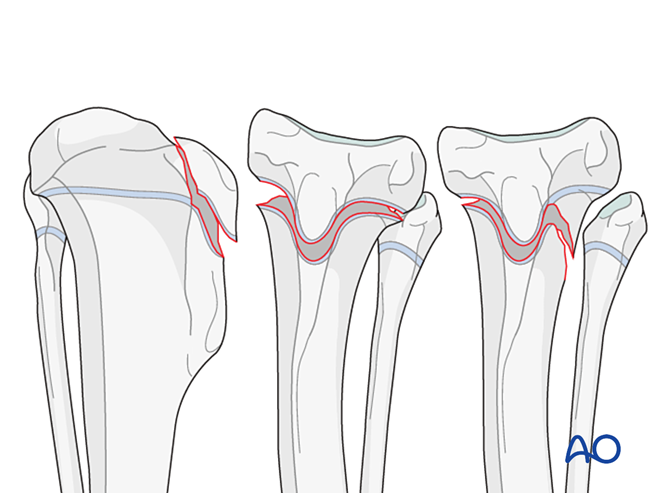 Physeal fractures