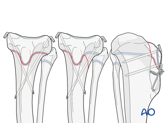 Physeal fractures