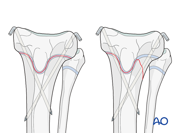 Physeal fractures