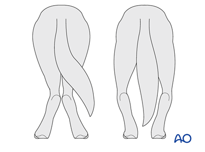 Physeal fractures