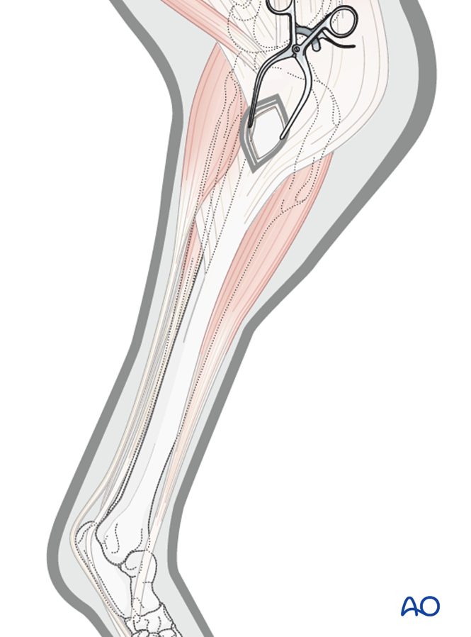 Approaches for minimally invasive osteosynthesis (MIO) to the dog ...