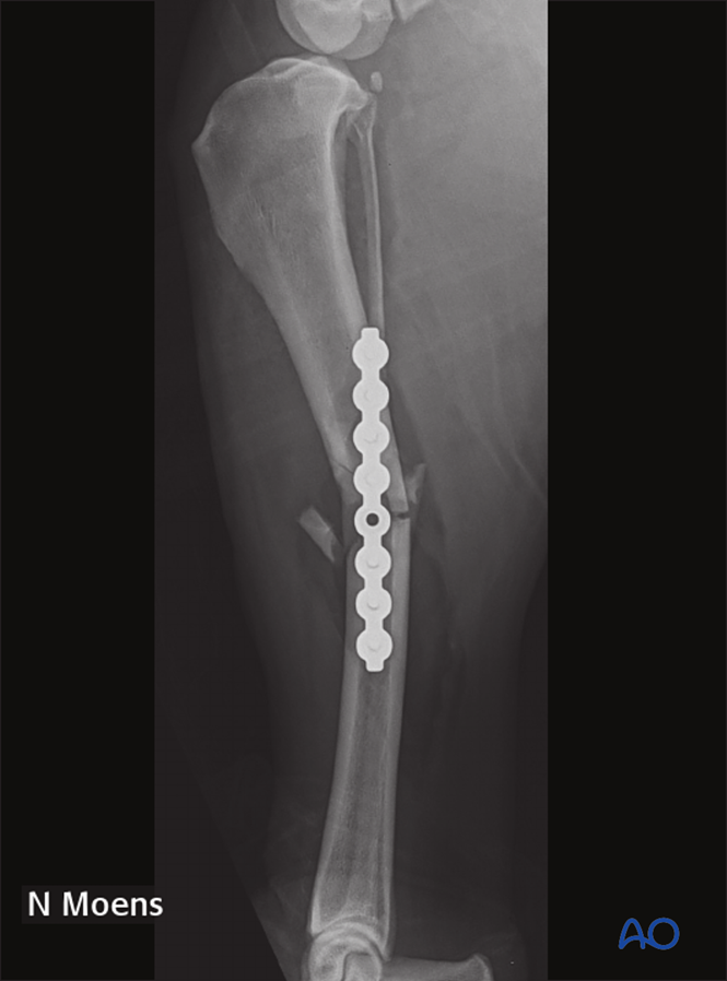 Complications with tibial shaft fractures