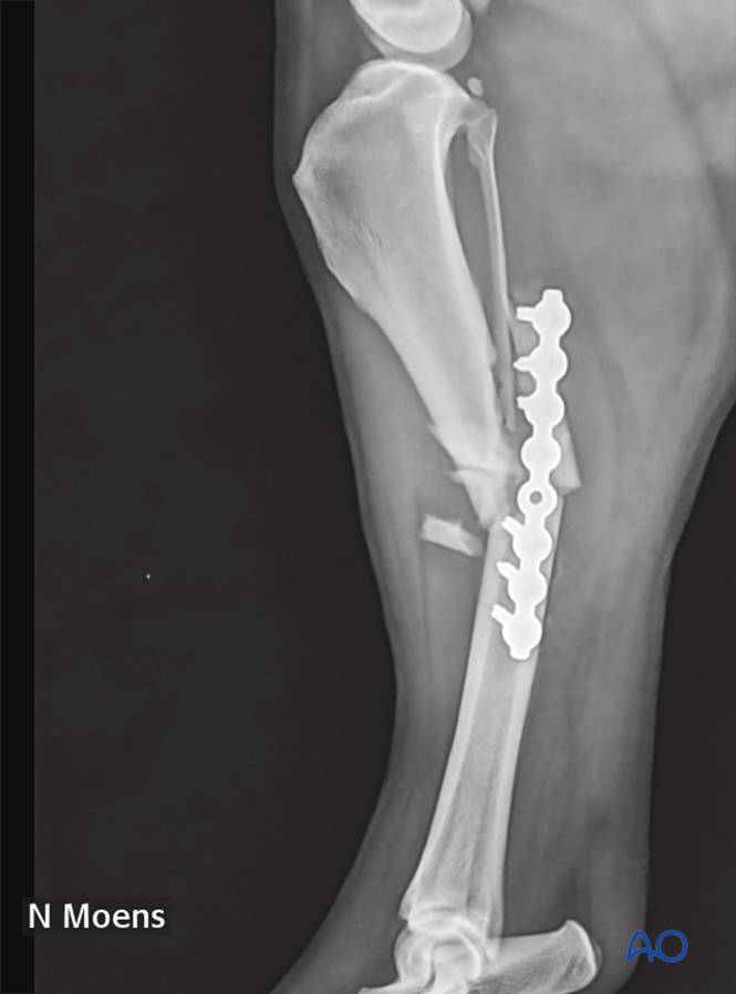 Complications with tibial shaft fractures