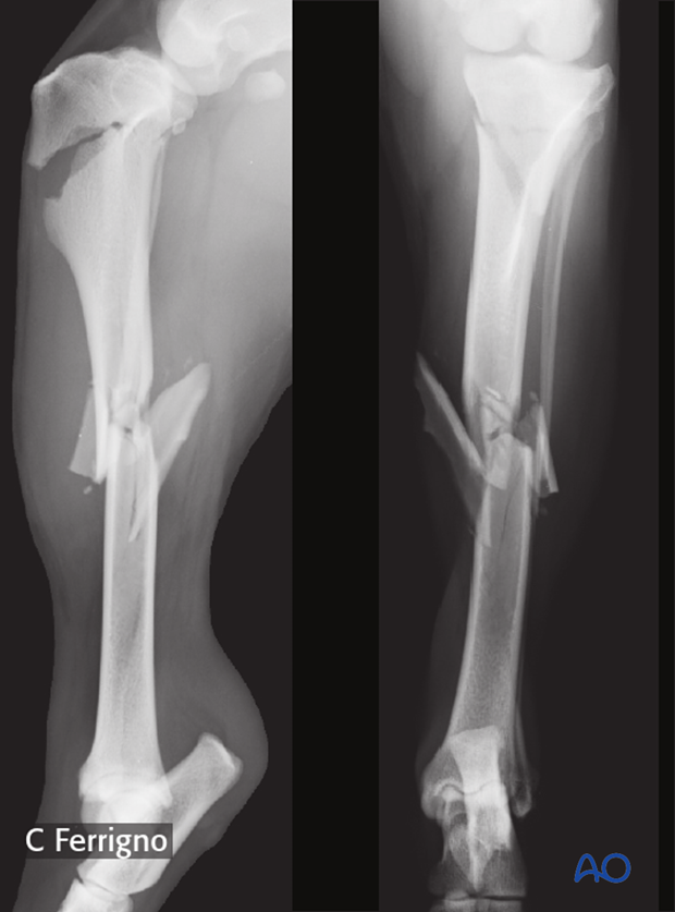 Complex segmental fracture