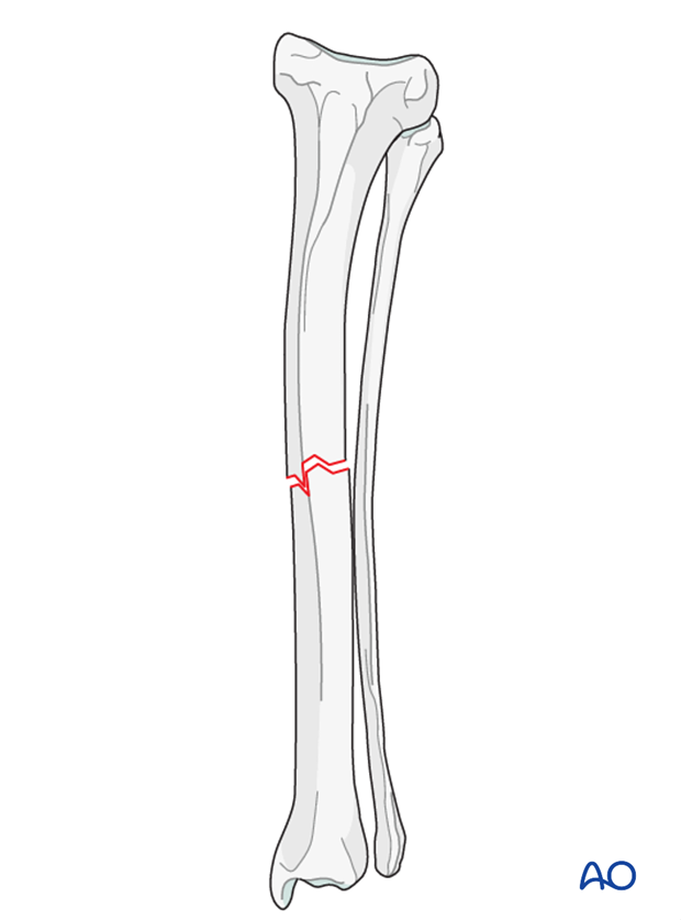Incomplete tibial fracture or fracture with fibula intact