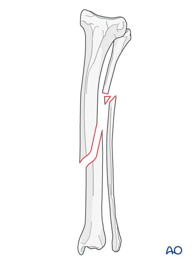 Simple oblique tibial fracture