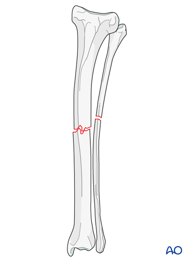 Simple transverse tibial fracture