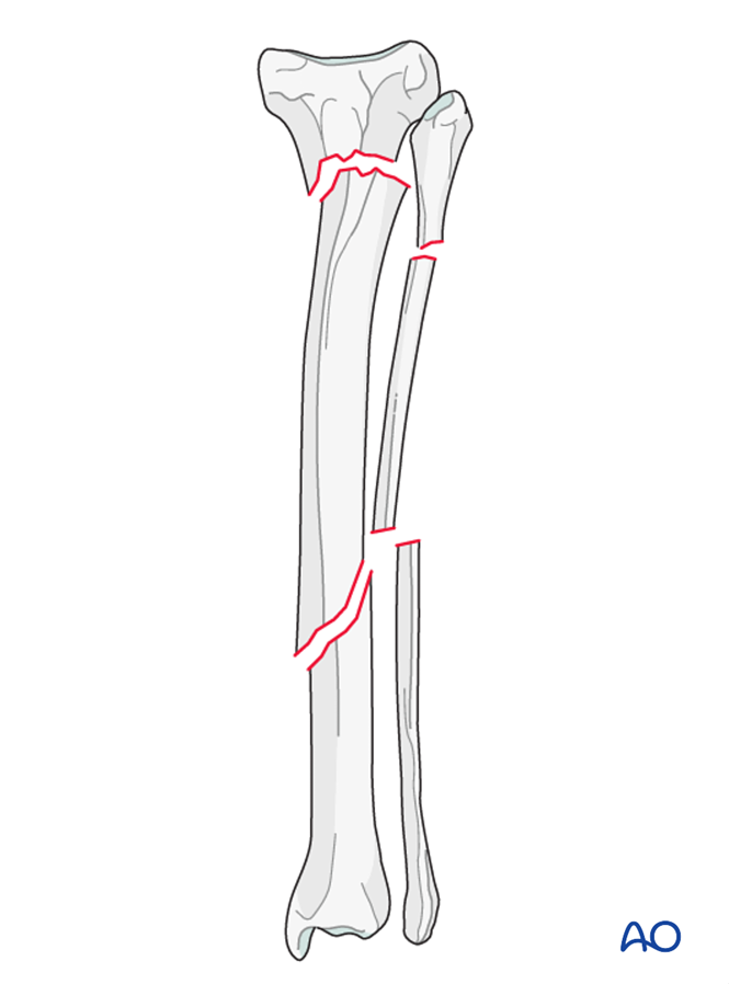 Complex segmental fracture