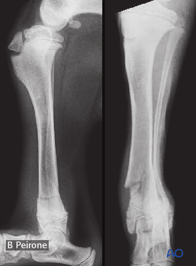 Nonsurgical fracture management for Incomplete fracture of the tibia or ...