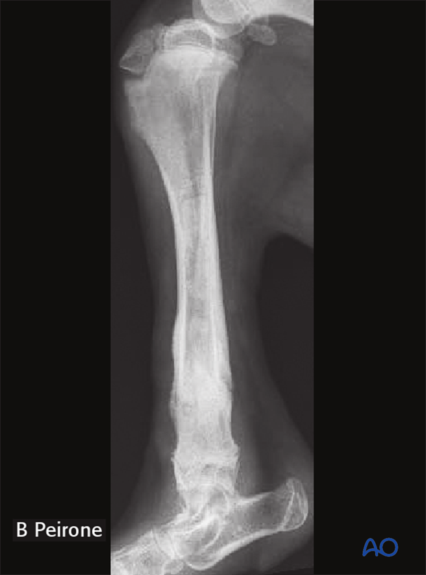 Nonsurgical fracture management for Incomplete fracture of the tibia or ...
