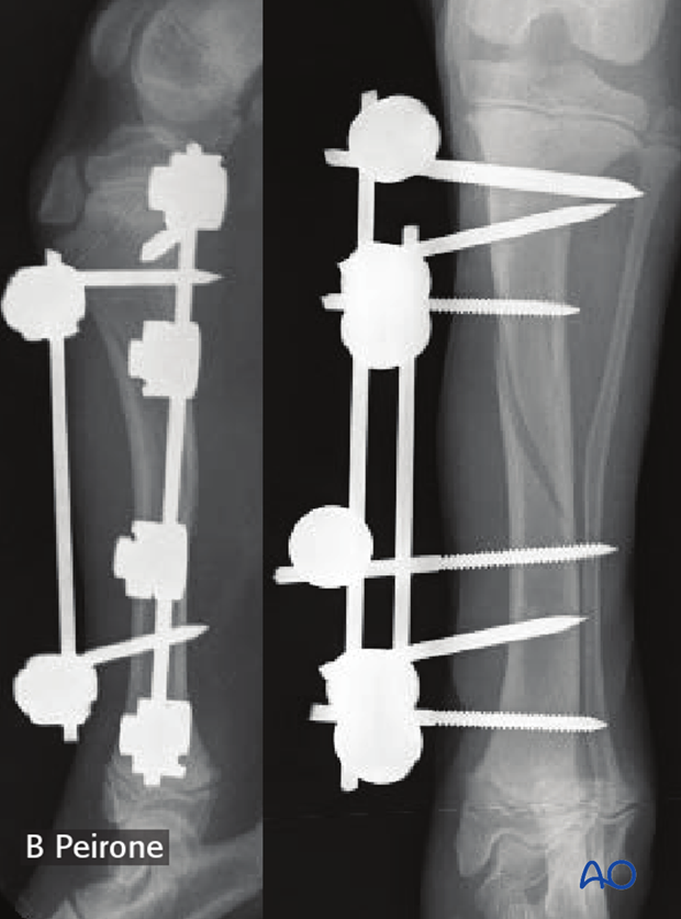 External fixator for Incomplete fracture of the tibia or complete ...