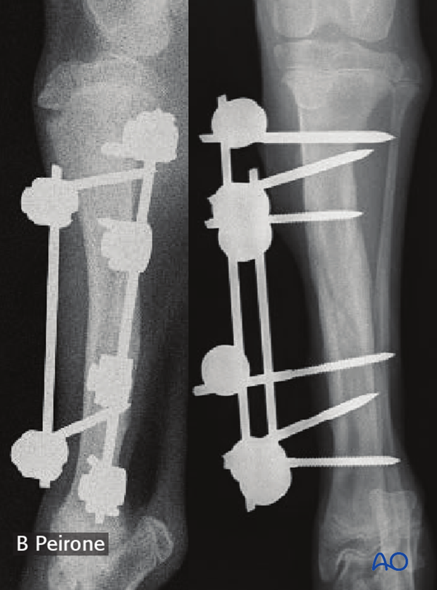 External fixator for Incomplete fracture of the tibia or complete ...