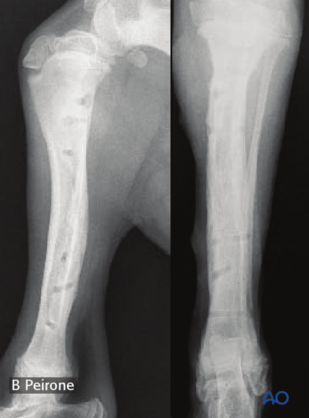 External fixator for Incomplete fracture of the tibia or complete ...