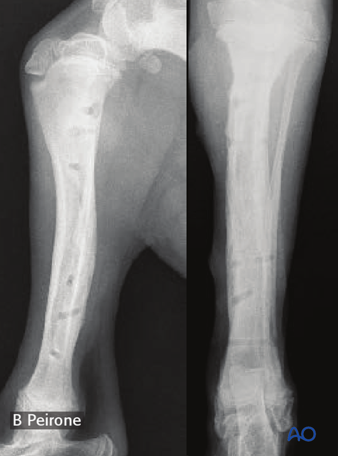 External fixator for Incomplete fracture of the tibia or complete ...