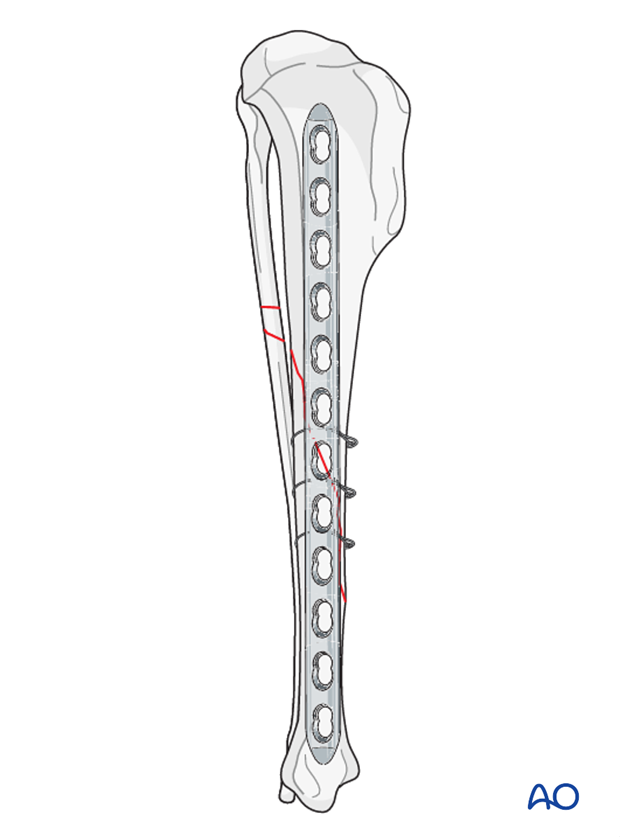 Lag screw or cerclage with neutralization plate for Simple oblique tibial