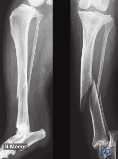 Simple oblique tibial fracture