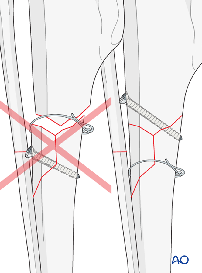 Lag screw or cerclage with neutralization plate for One large reducible ...