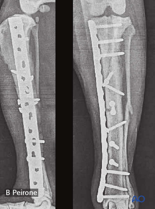 Lag screw with neutralization plate for Several reducible wedges in the ...