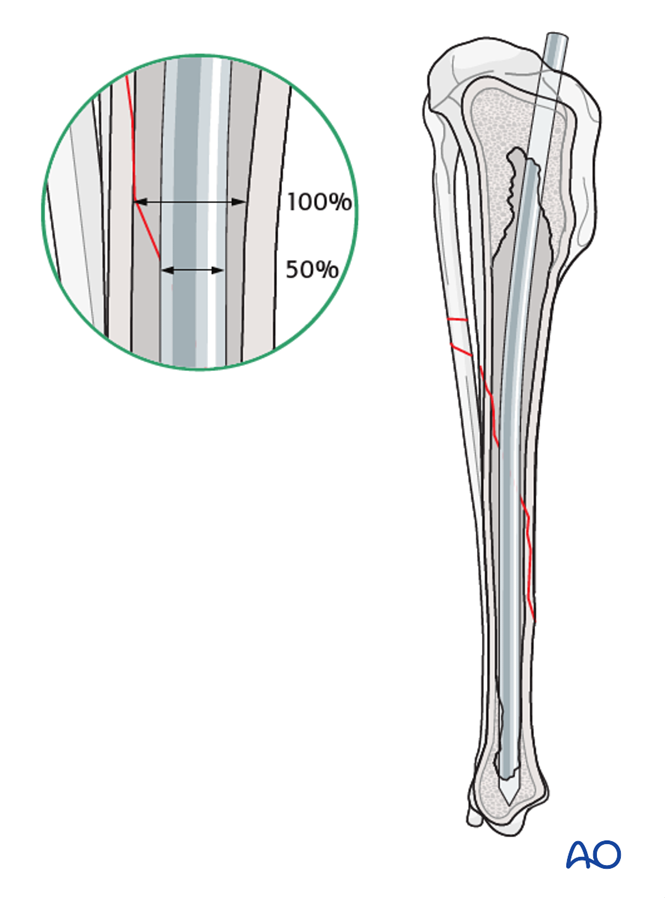 IM pin and cerclage wires for Simple oblique tibial