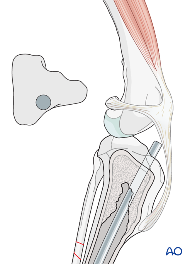 IM pin and cerclage wires for Simple oblique tibial