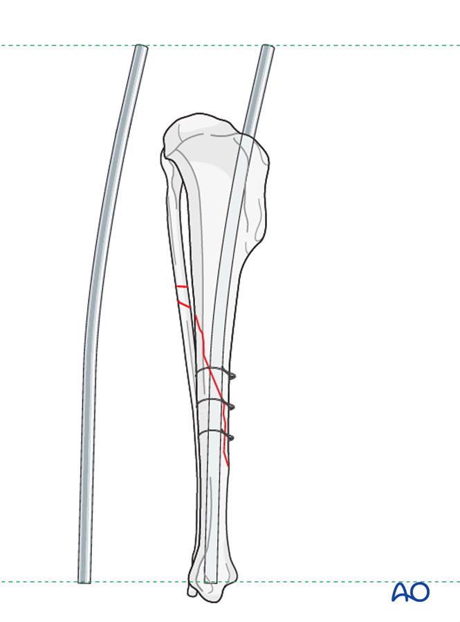 IM pin and cerclage wires for Simple oblique tibial