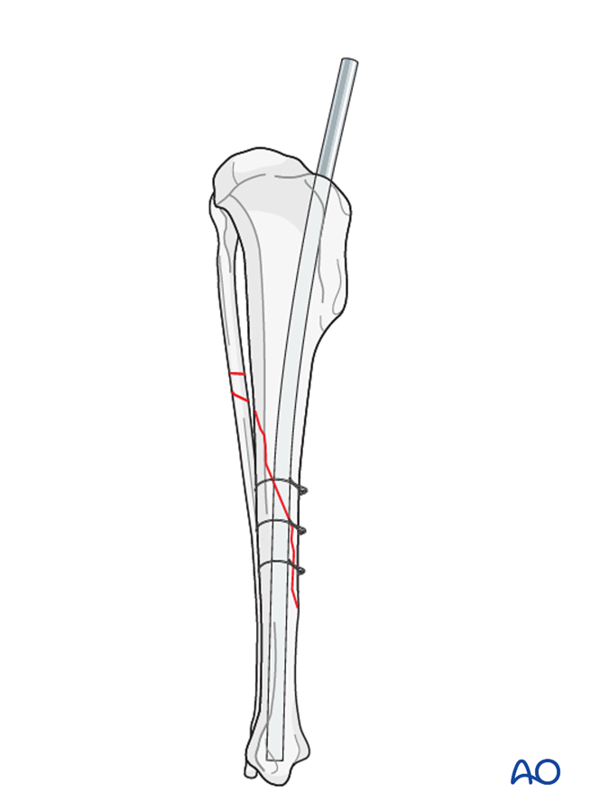 IM pin and cerclage wires for Simple oblique tibial