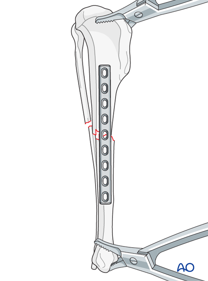 Compression plate for Simple transverse tibial